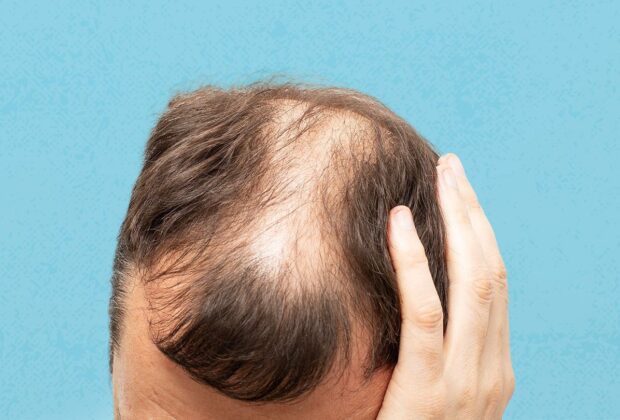 Different types of baldness to know
