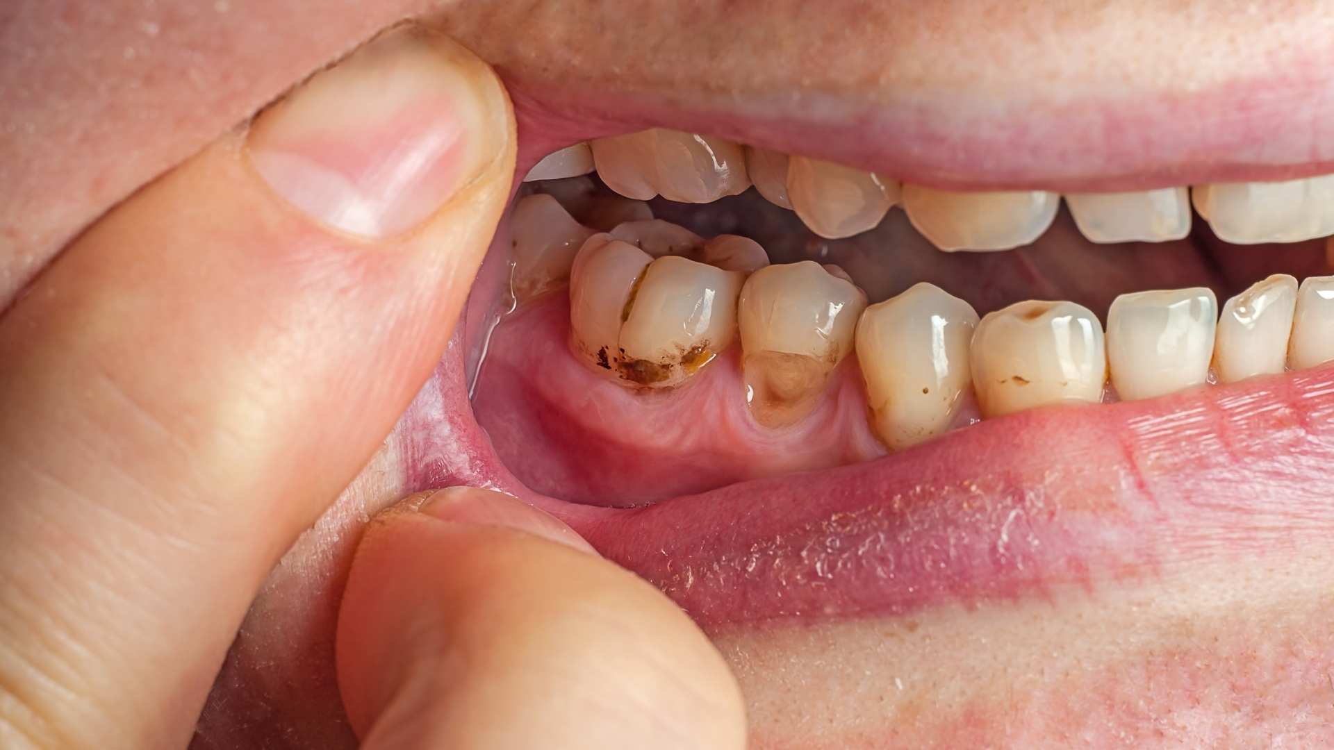 TOP SIGNS OF TOOTH DECAY